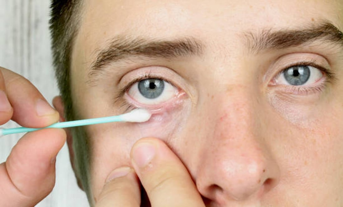 ¿Qué es el síndrome del ojo seco y qué relación tiene con la ola de ...