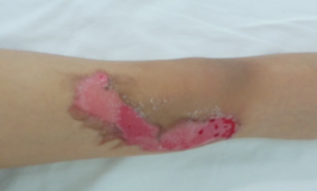 Injerto de piel cultivada salva a niña de 7 años | El Universal